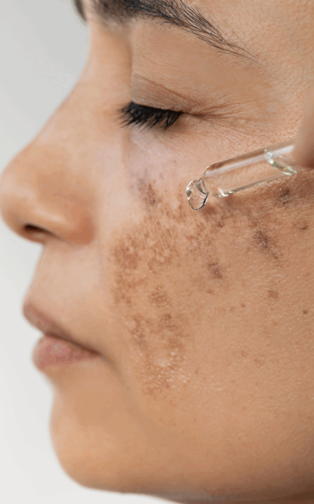 Best Treatment for Pigmentation: 5 Reasons It Isn’t Going Away ...