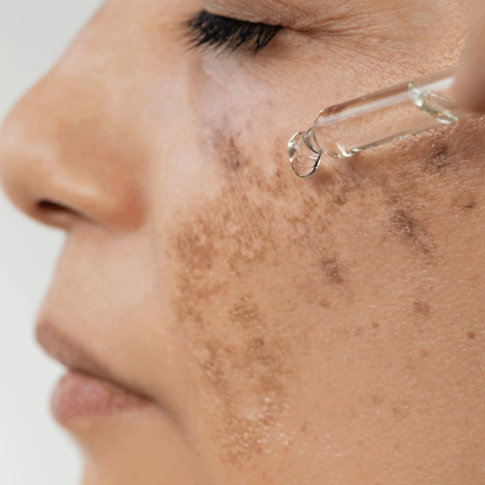 Best Treatment for Pigmentation: 5 Reasons It Isn’t Going Away ...