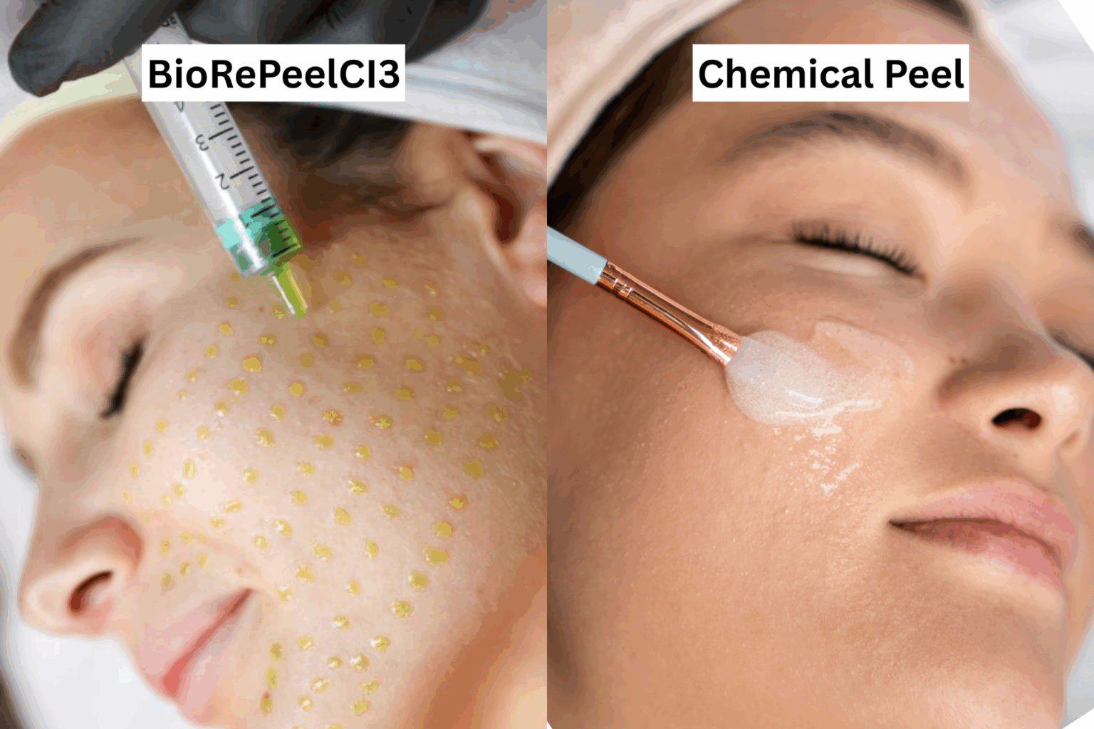 BioRePeel vs Chemical Peels – What’s Safer for Your Skin?