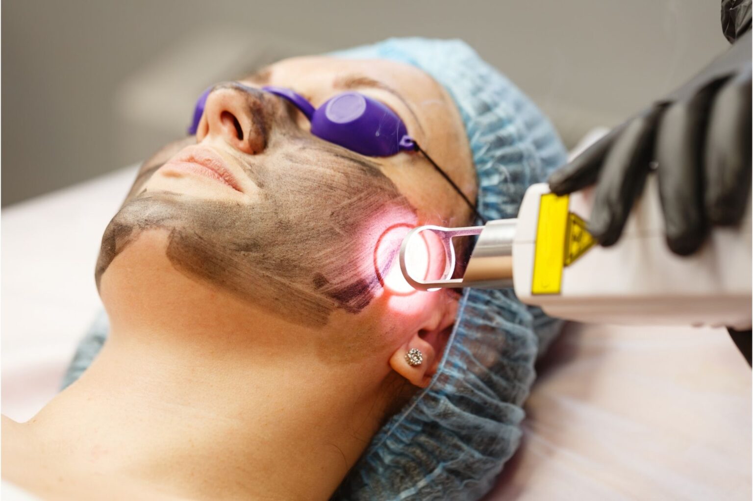 Top Pigmentation Treatment in Delhi – Paradise Wellness