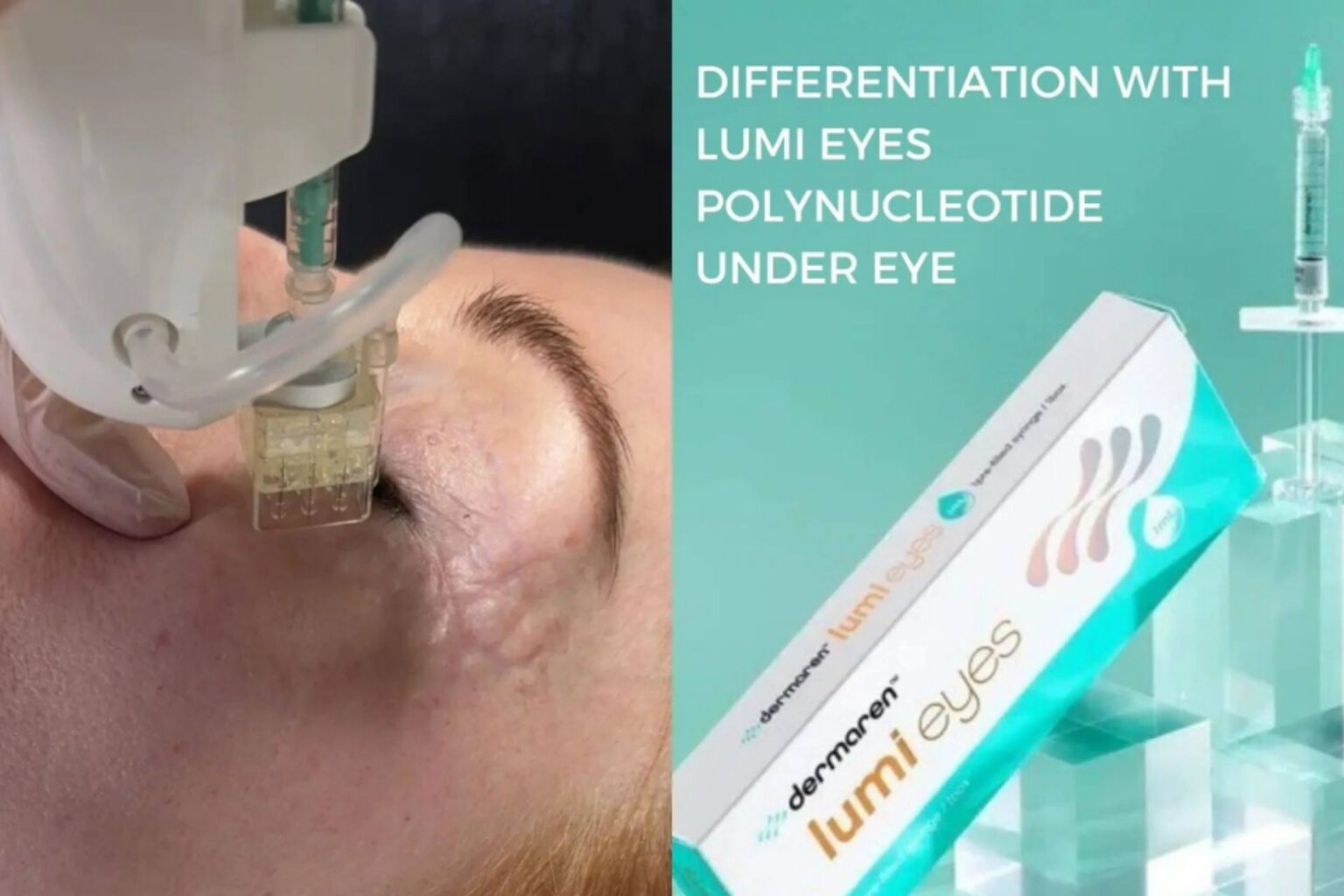 Lumi Eyes Treatment: 7 Amazing Benefits You Need to Know – Paradise ...