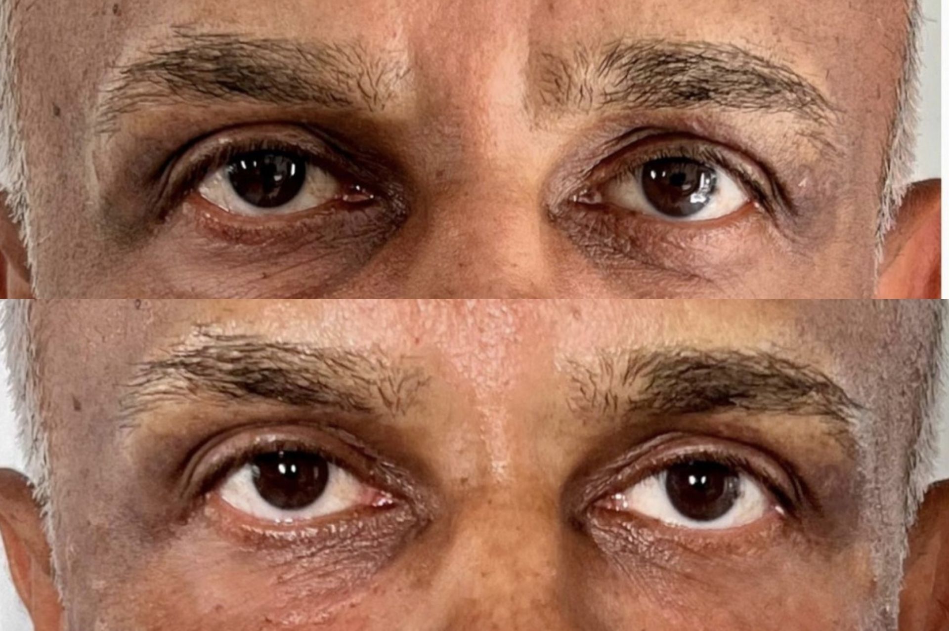 Lumi Eyes Treatment: How Long Does Lumi Eyes Take to Work?