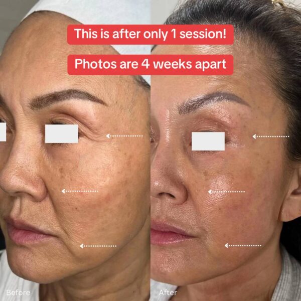 7 Powerful Benefits of Polynucleotide Treatment for Glowing Skin in ...