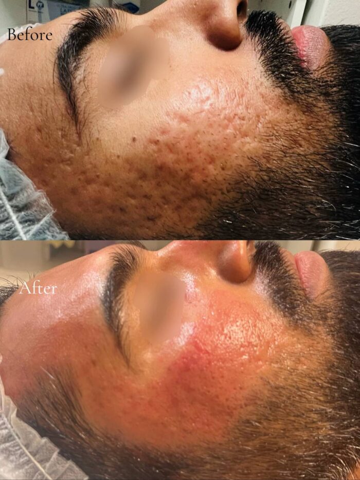 Subcision Treatment for Acne Scars in Delhi: Cost, Procedure